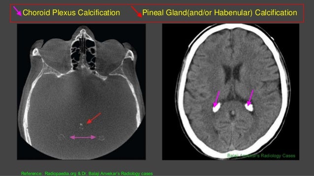Intracranial Calcification in Cone Beam CT & Medical CT