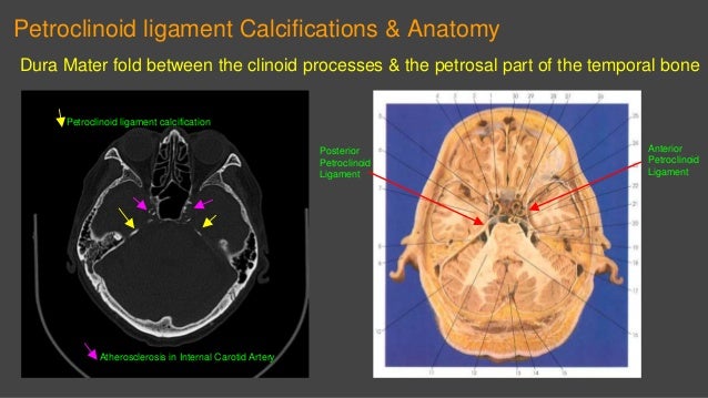 Intracranial Calcification in Cone Beam CT & Medical CT