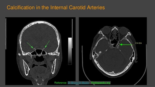 Intracranial Calcification in Cone Beam CT & Medical CT