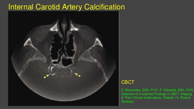 Carotid Artery Calcification