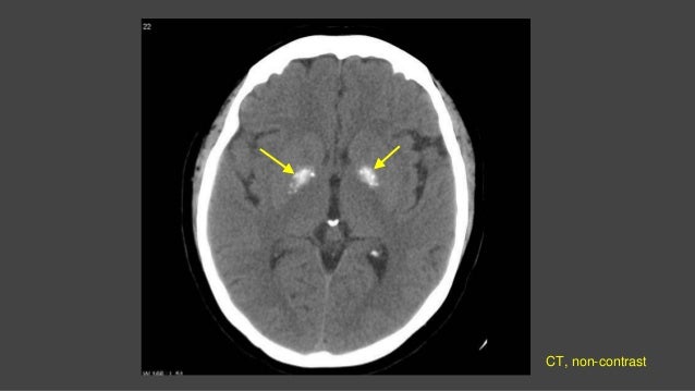 Habenular Calcification