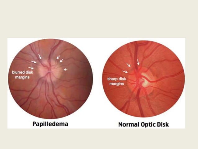 Presentation on intracranial complications of CSOM | PPT