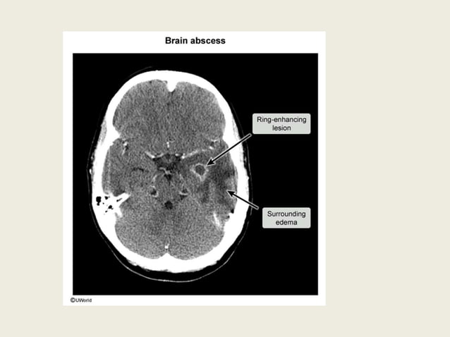 Presentation on intracranial complications of CSOM | PPT