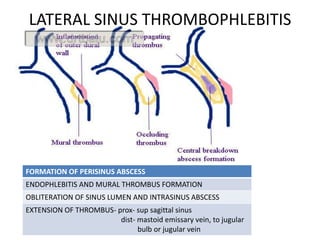 Intracranial complication of chronic suppurative otitis media | PPSX