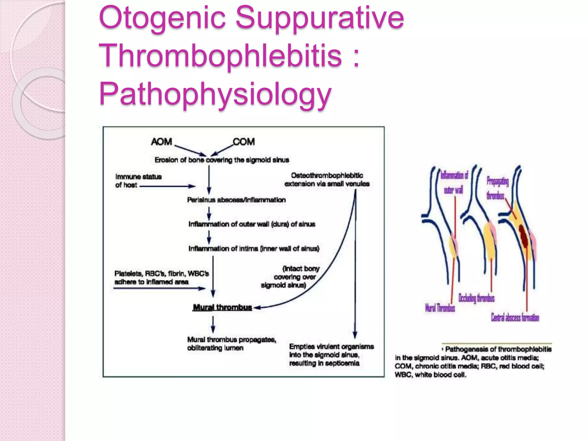Intracranial complications of chronic otitis media | PPTX