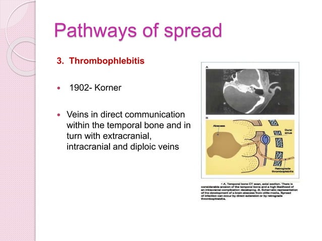 Intracranial complications of chronic otitis media | PPTX | Ear, Nose and Throat Conditions ...