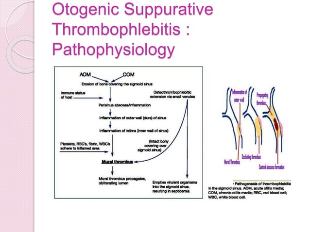 Intracranial complications of chronic otitis media | PPTX | Ear, Nose and Throat Conditions ...