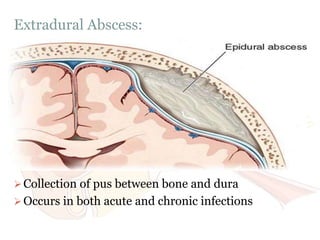 Intracranial complications of csom | PPTX