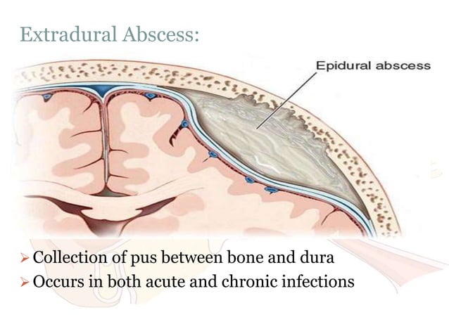 Intracranial complications of csom | PPTX