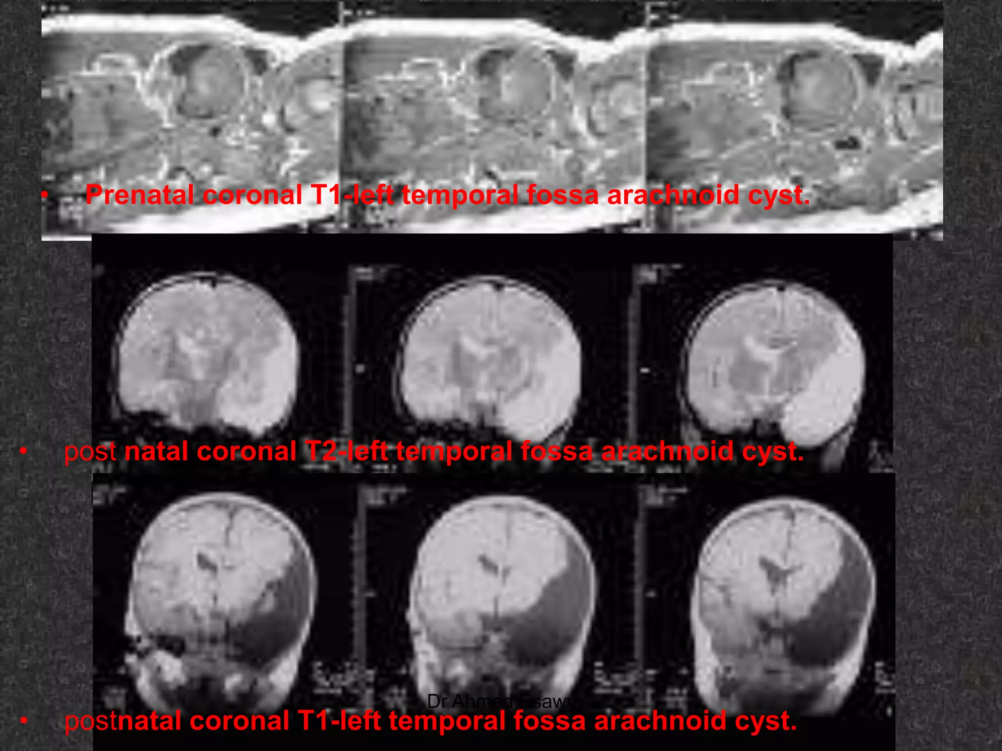 Intracranial congenital cystic lesion Dr Ahmed Esawy CT MRI part 2 | PDF