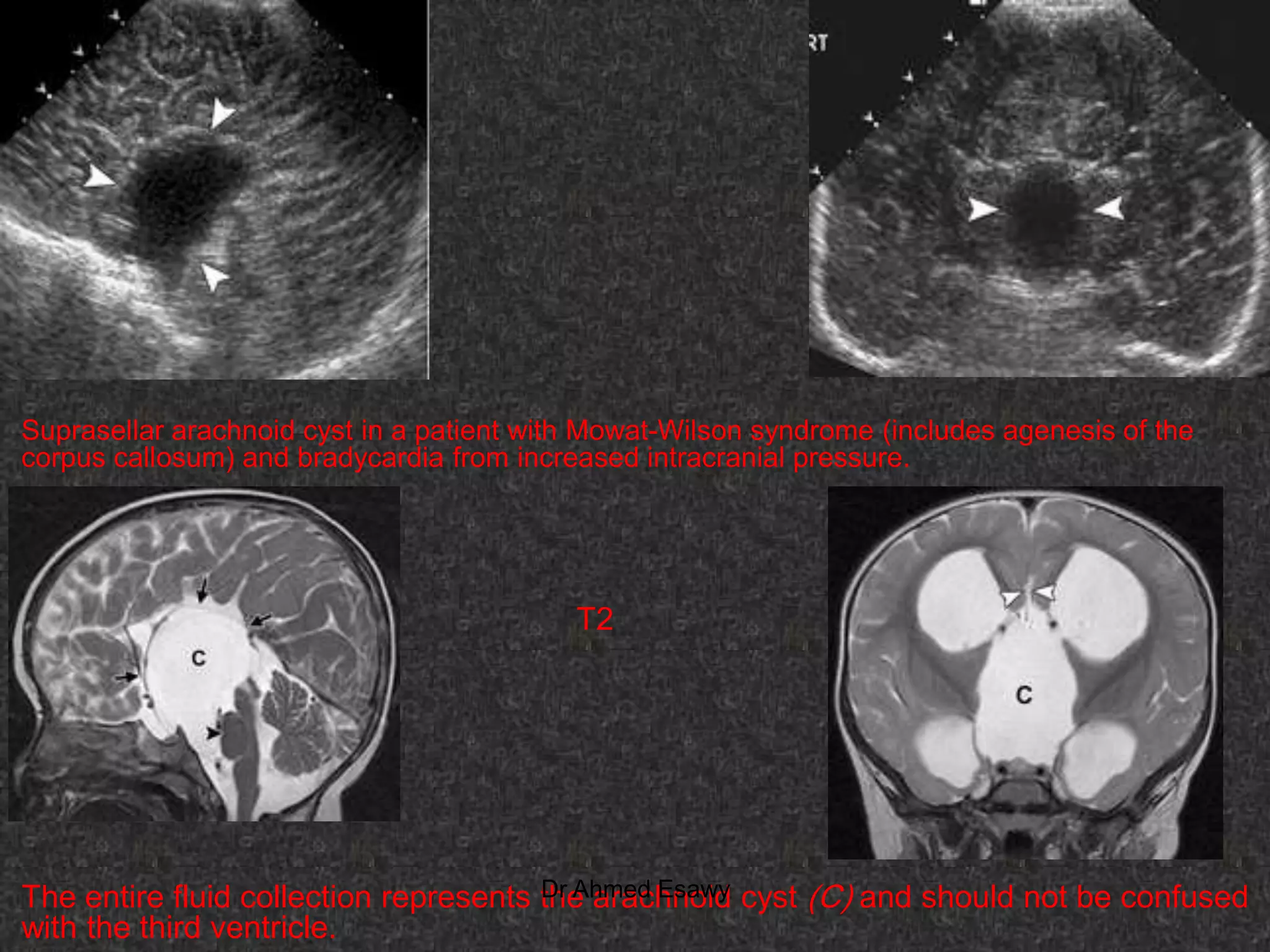 Intracranial congenital cystic lesion Dr Ahmed Esawy CT MRI part 2 | PDF