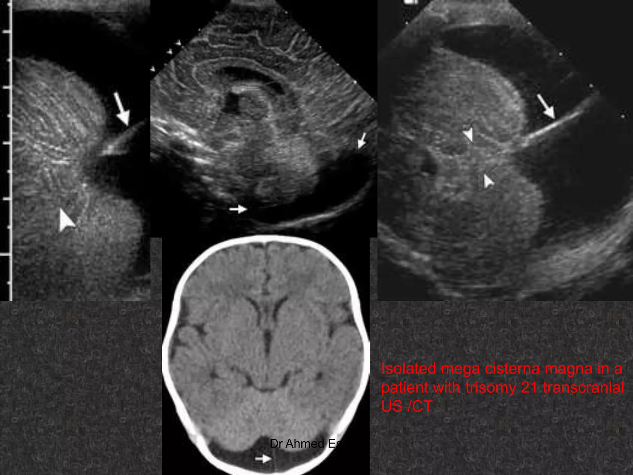 Intracranial congenital cystic lesion Dr Ahmed Esawy CT MRI part 2 | PDF