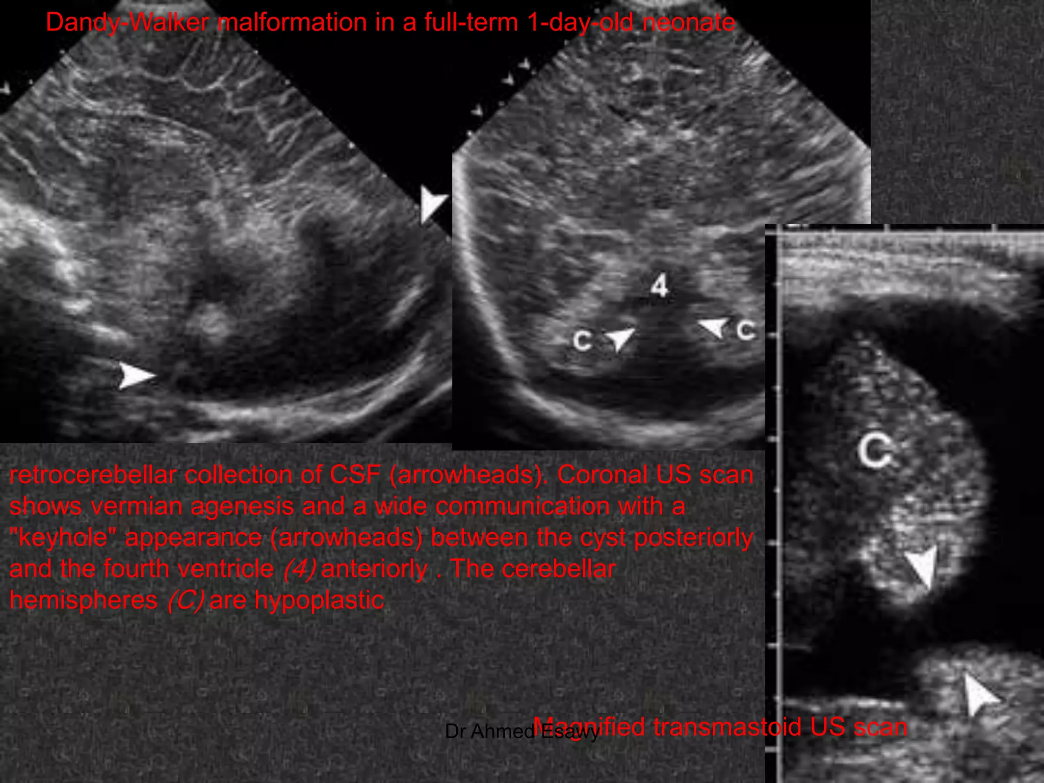 Intracranial congenital cystic lesion Dr Ahmed Esawy CT MRI part 2 | PDF