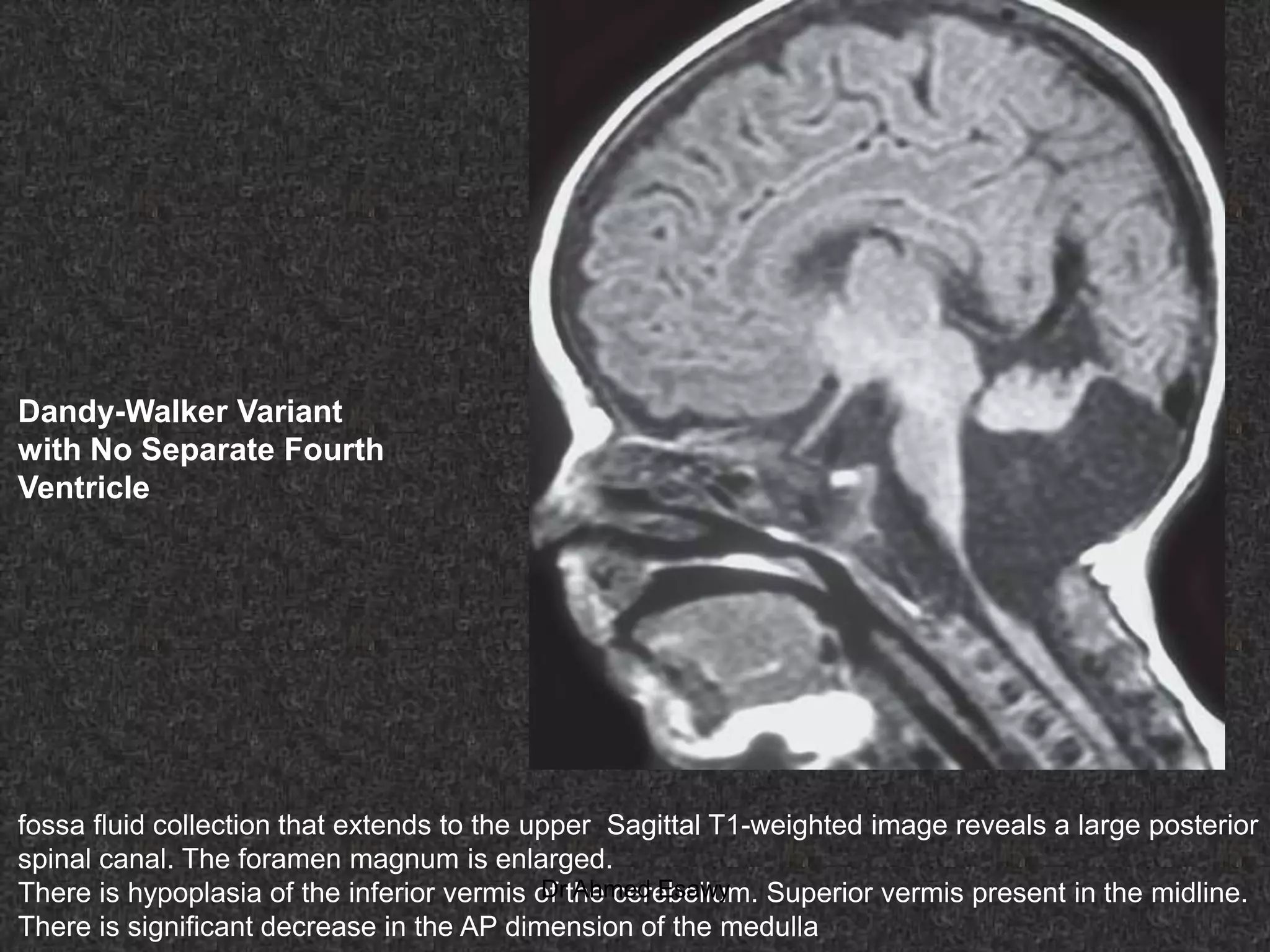 Intracranial congenital cystic lesion Dr Ahmed Esawy CT MRI part 2 | PDF