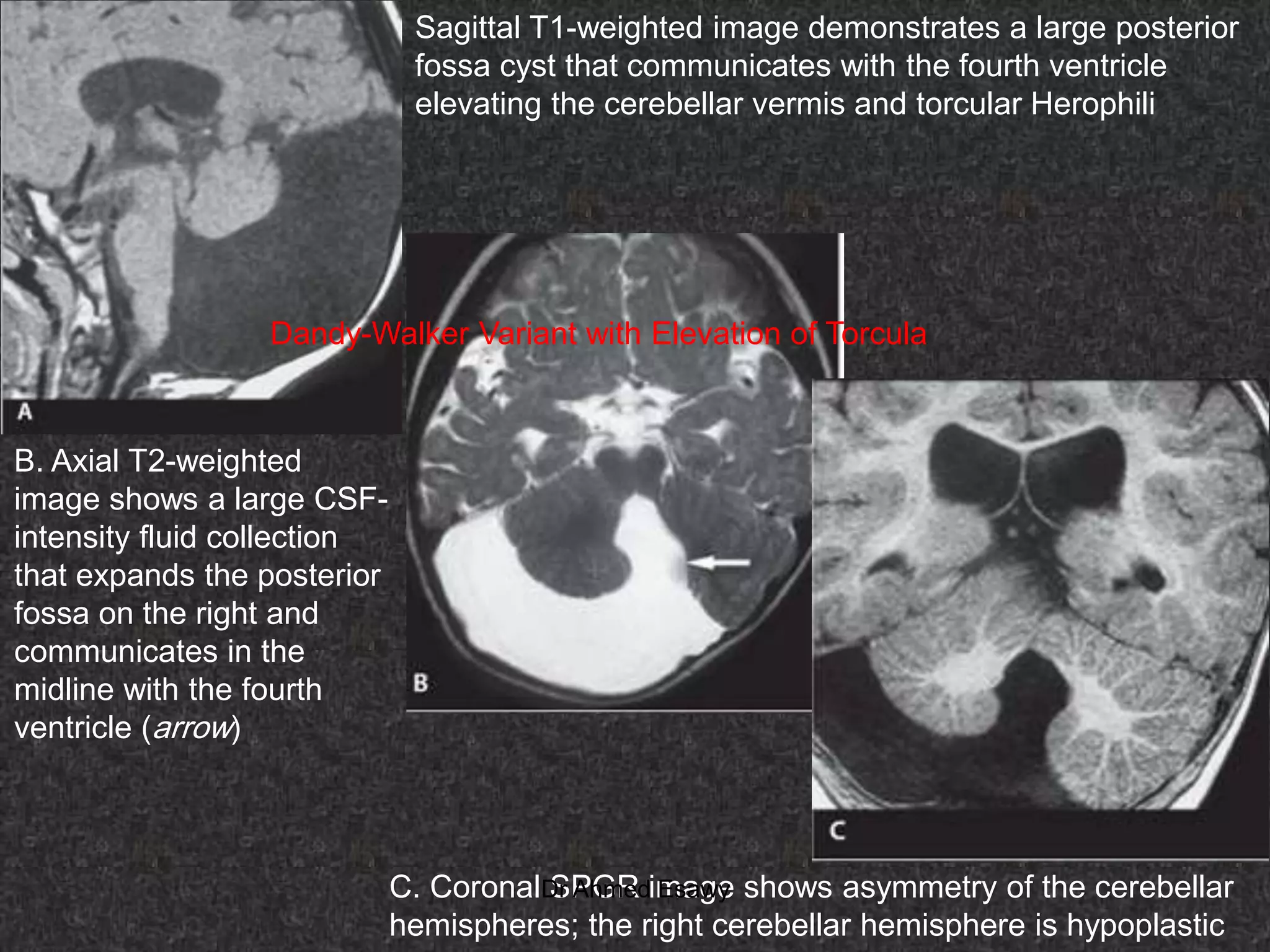 Intracranial congenital cystic lesion Dr Ahmed Esawy CT MRI part 2 | PDF