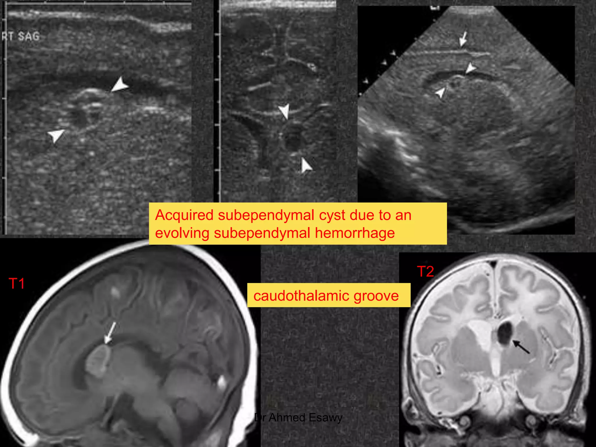 Intracranial congenital cystic lesion Dr Ahmed Esawy CT MRI part 2 | PDF