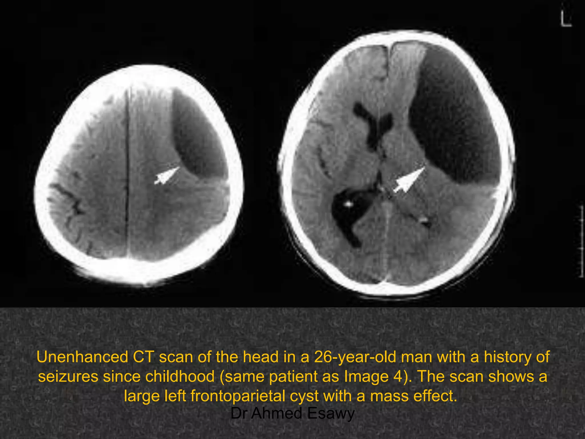 Intracranial congenital cystic lesion Dr Ahmed Esawy CT MRI part 2 | PDF