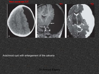 Intracranial congenital cystic lesion Dr Ahmed Esawy CT MRI part 2 | PDF