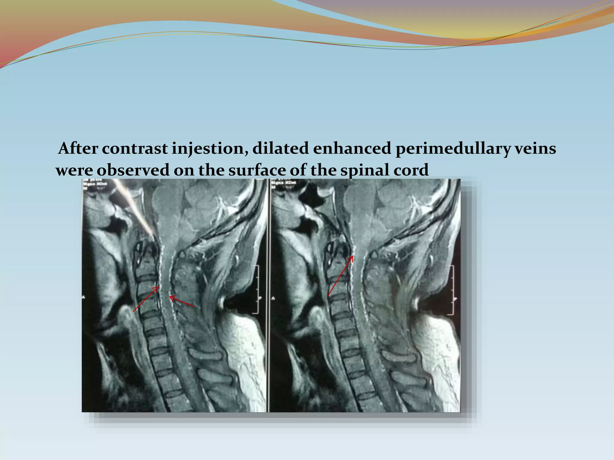 Intracranial dural av fistula with spinal perimedullary venous drainage ...