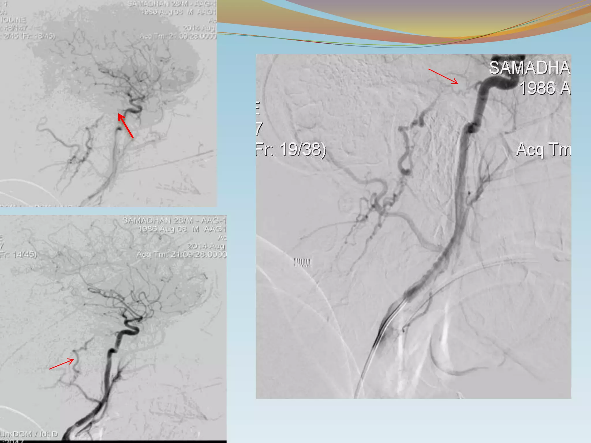 Intracranial dural av fistula with spinal perimedullary venous drainage ...