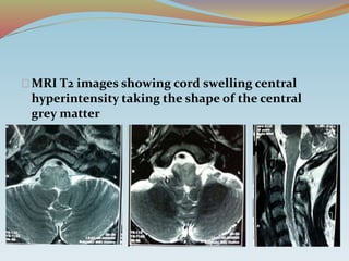 Intracranial dural av fistula with spinal perimedullary venous drainage ...