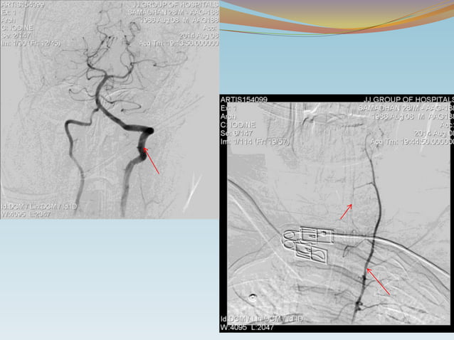 Intracranial dural av fistula with spinal perimedullary venous drainage ...