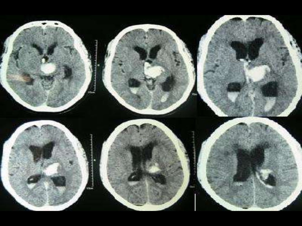 Intracranial hemorrhage- shruthi s jayaraj, calicut medical college