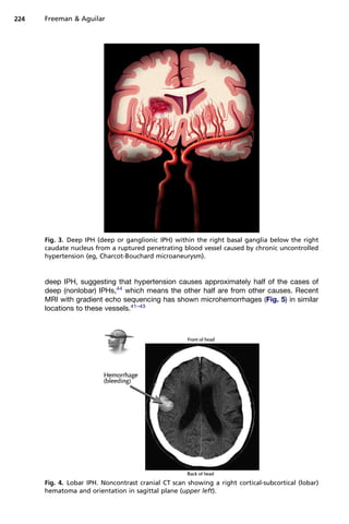 Intracranial hemorrhage. neurol clin | PDF