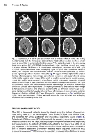 Intracranial hemorrhage. neurol clin | PDF