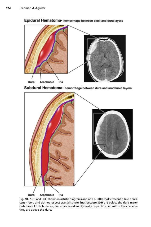 Intracranial hemorrhage. neurol clin