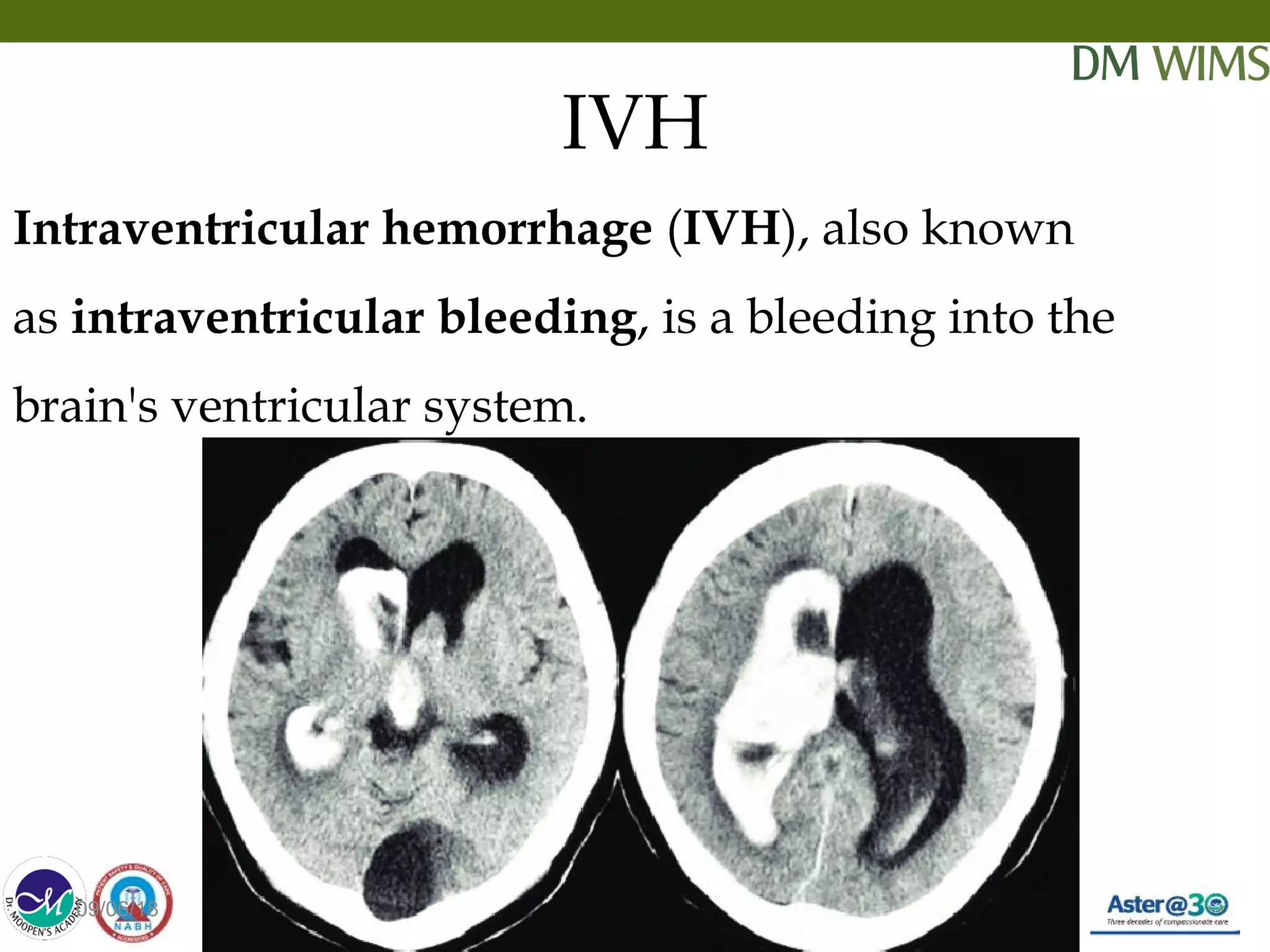 Intracranial hemorrhage,intracerebral Hemorrhage,Brain Bleed | PPT