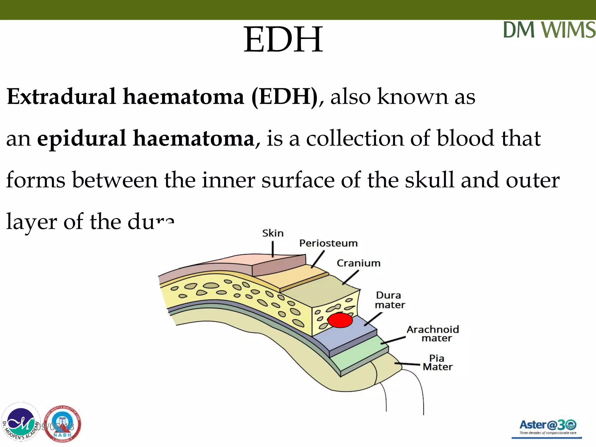Intracranial hemorrhage,intracerebral Hemorrhage,Brain Bleed | PPT