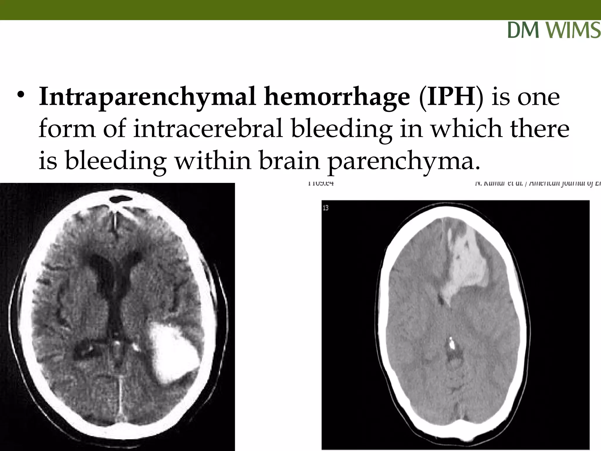 Intracranial hemorrhage,intracerebral Hemorrhage,Brain Bleed | PPT
