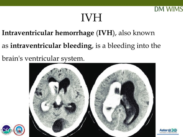 Intracranial hemorrhage,intracerebral Hemorrhage,Brain Bleed | PPT