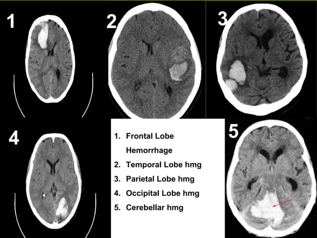 Intracranial hemorrhage,intracerebral Hemorrhage,Brain Bleed | PPT