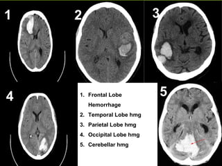Traumatic Intracerebral Hemorrhage