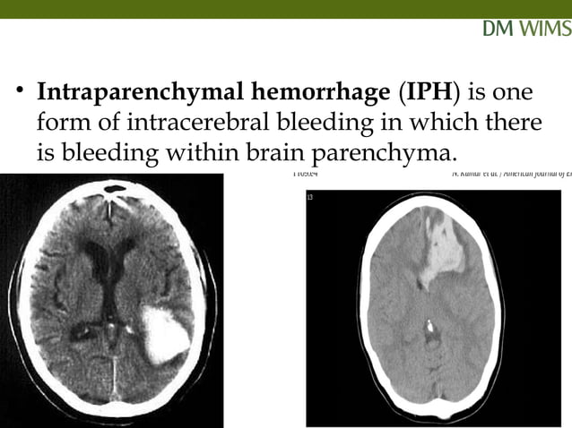 Intracranial hemorrhage,intracerebral Hemorrhage,Brain Bleed