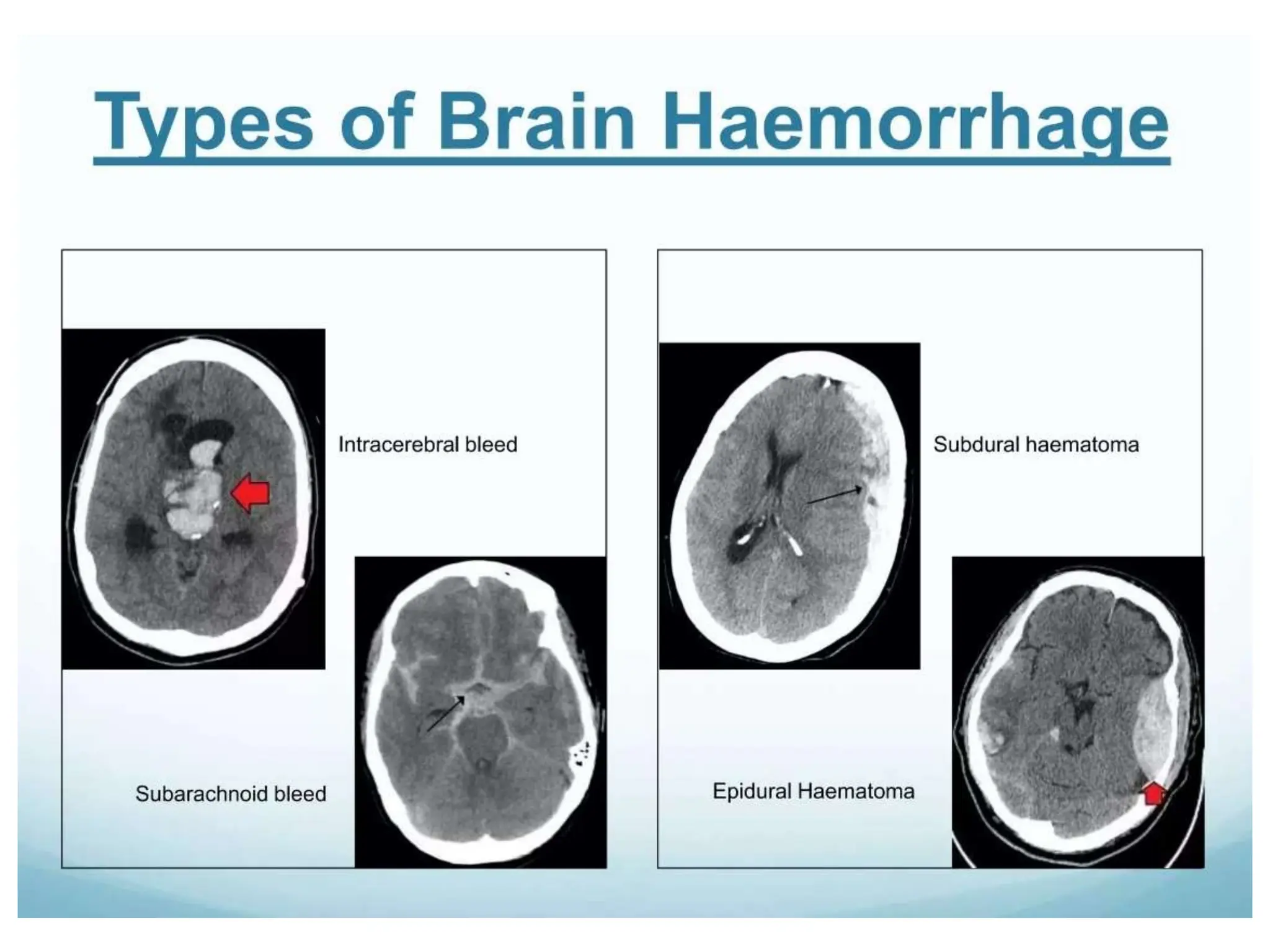 intracranial hemorrhage by Dr sherya Sharma Fortis | PPTX