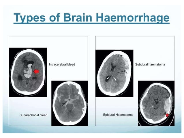 intracranial hemorrhage by Dr sherya Sharma Fortis | PPTX