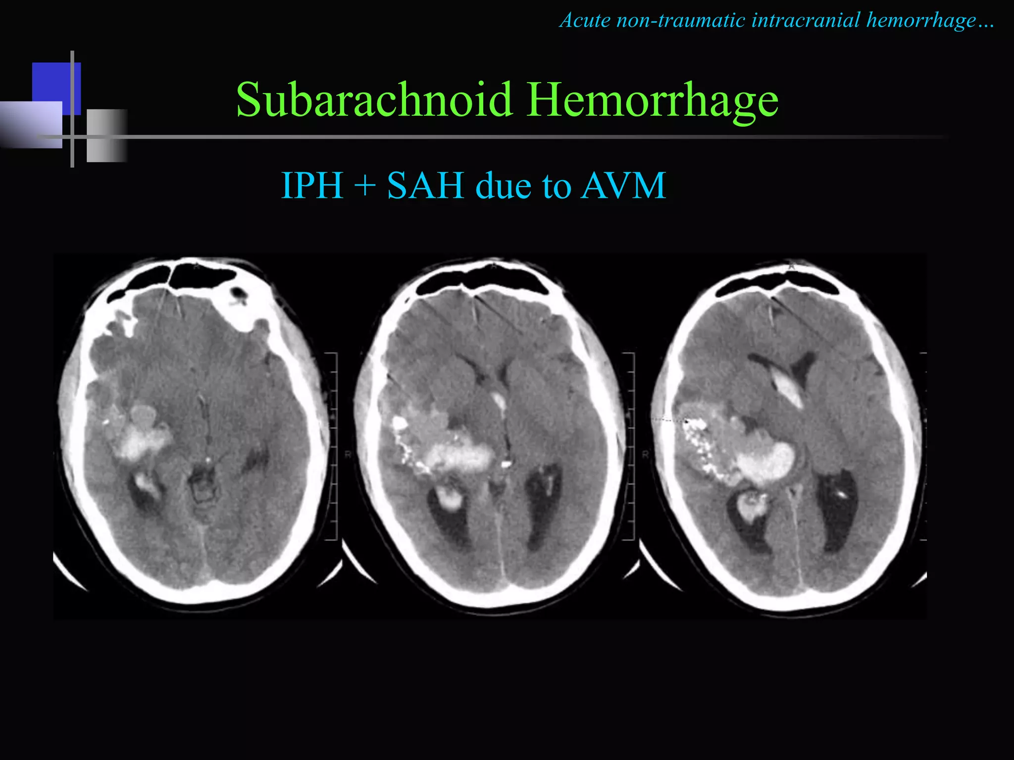 Intracranial hemorrhage dr.manohar | PPTX