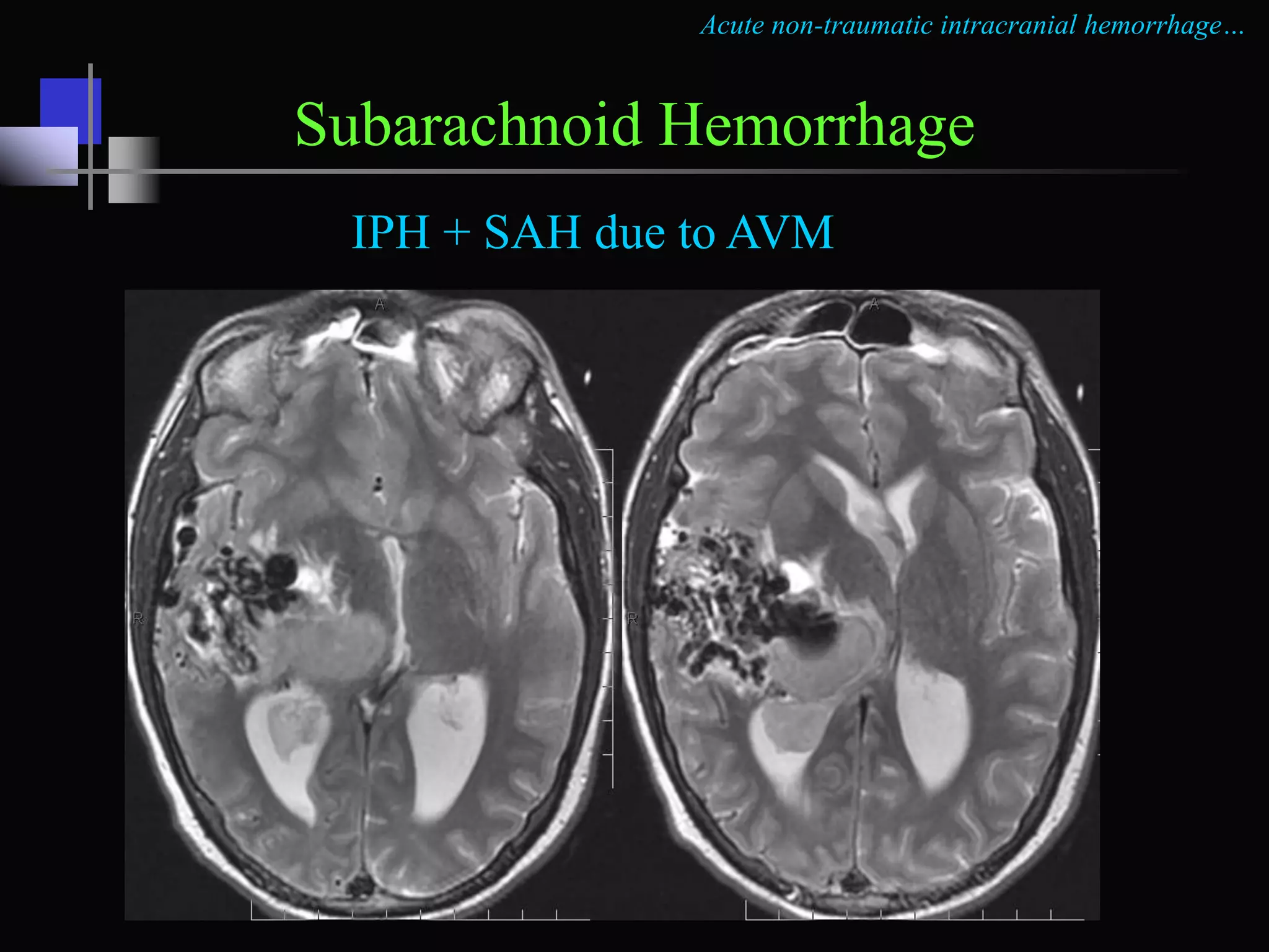 Intracranial hemorrhage dr.manohar | PPTX