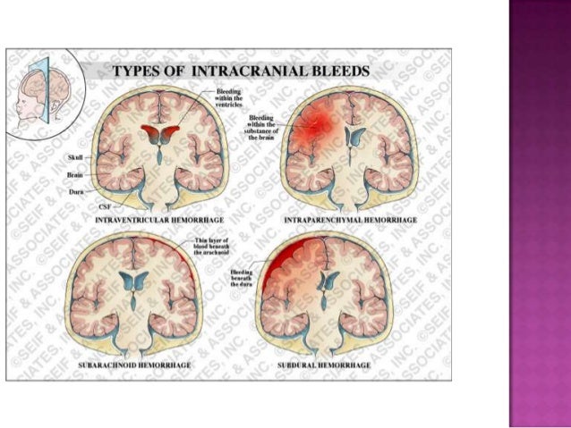 Intracranial hemorrhage newborn