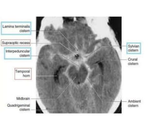 Intra cranial hemorrhages agp | PPTX
