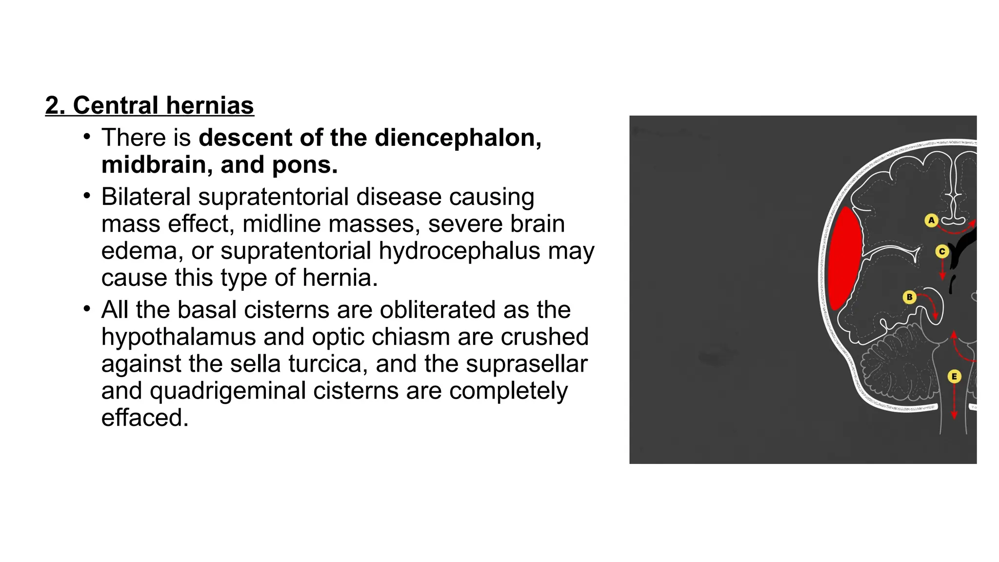 INTRACRANIAL HERNIATIONS -various types and anatomy.pptx