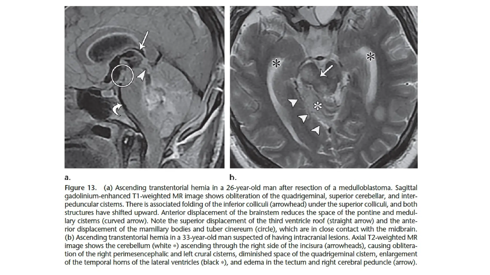 INTRACRANIAL HERNIATIONS -various types and anatomy.pptx