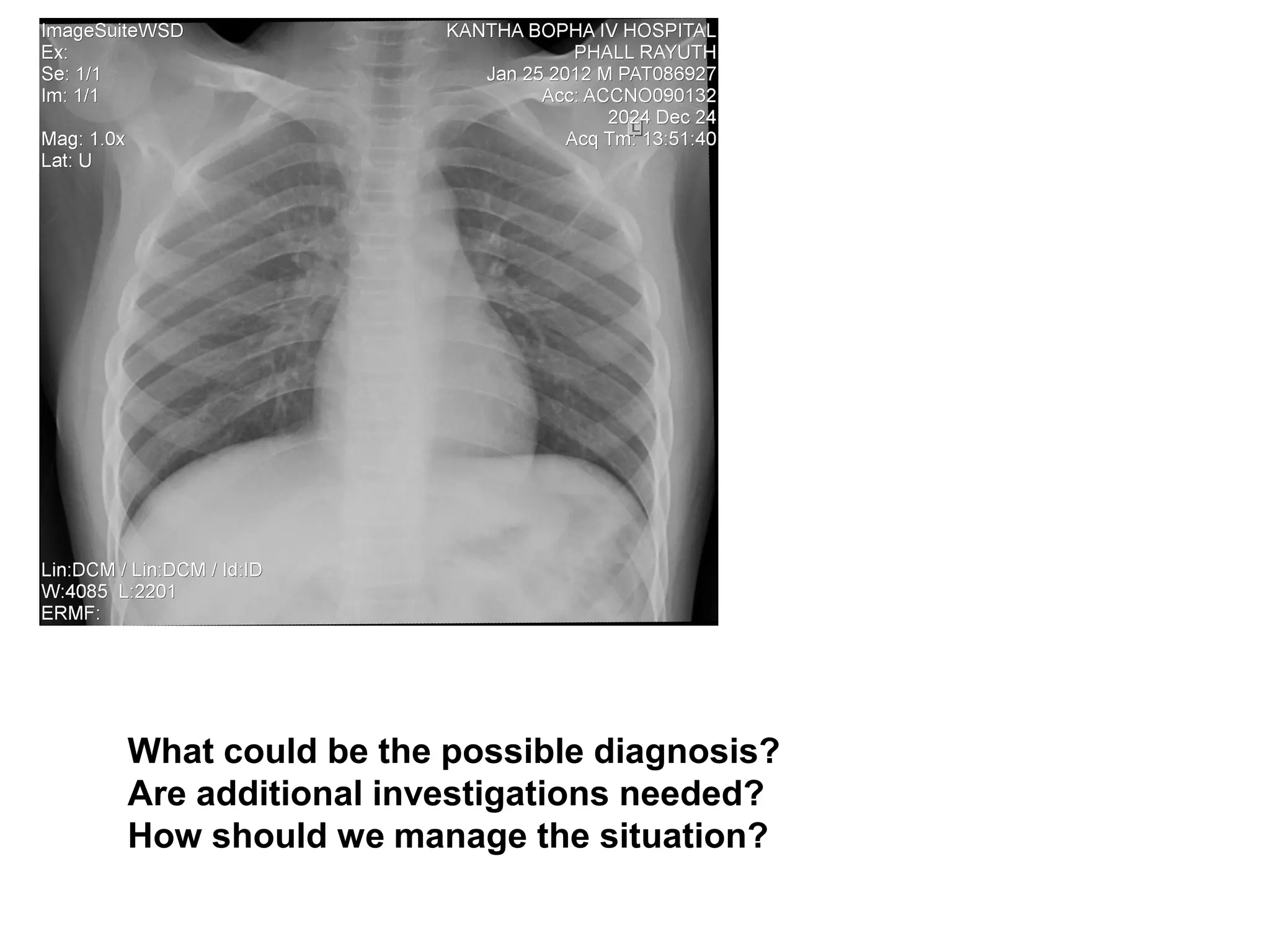 Intracranial Hypertension In Children-2025.pdf