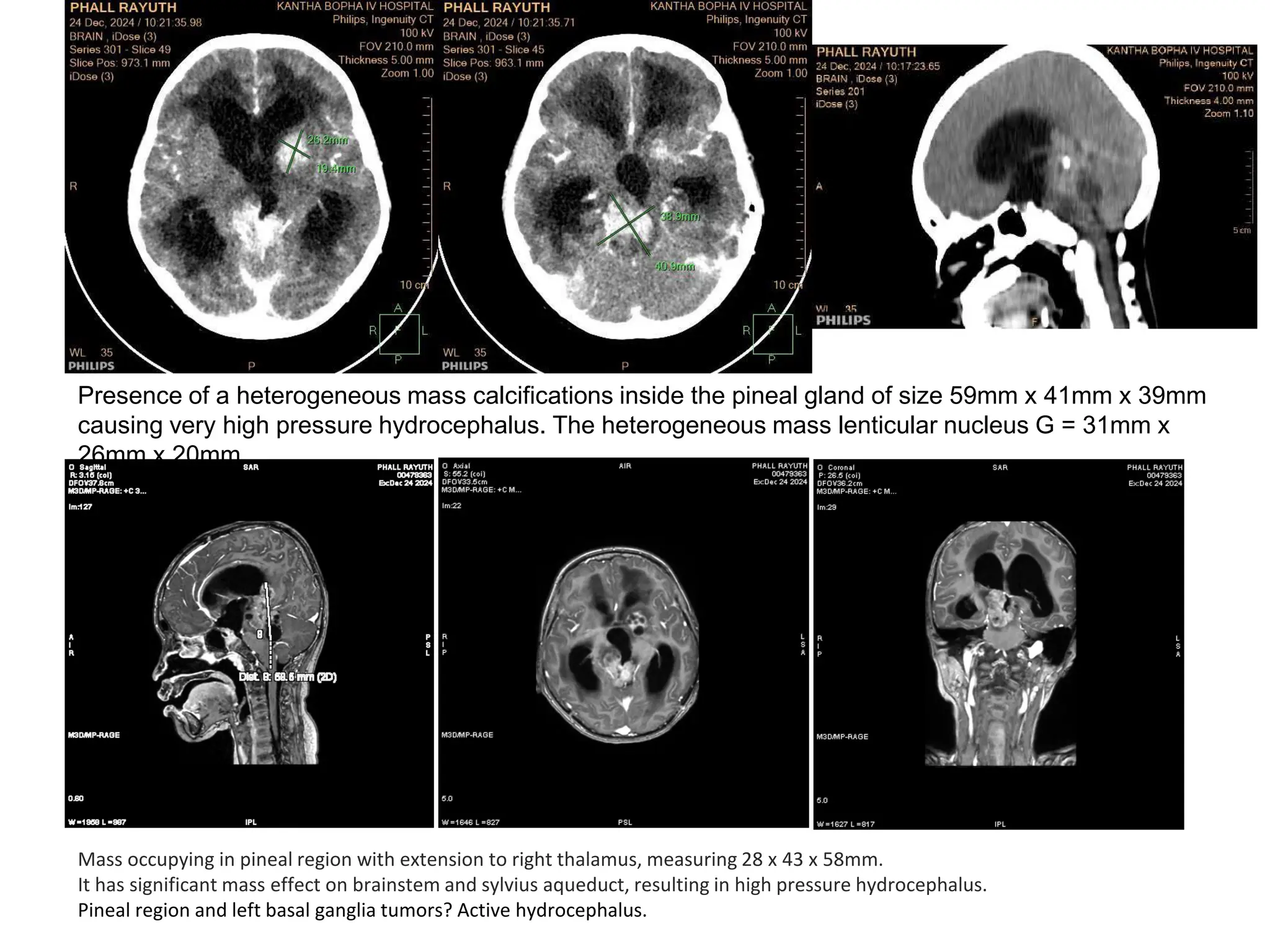 Intracranial Hypertension In Children-2025-compressed.pdf