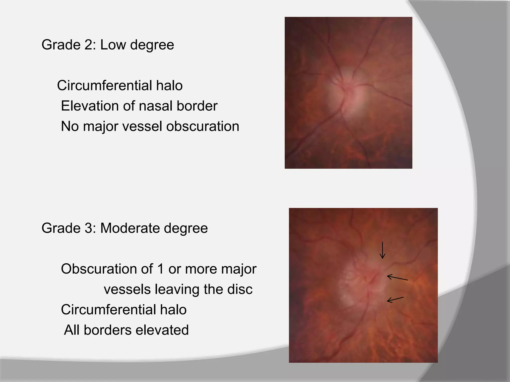 Intracranial hypertension | PPTX