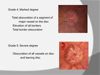 Intracranial hypertension | PPTX