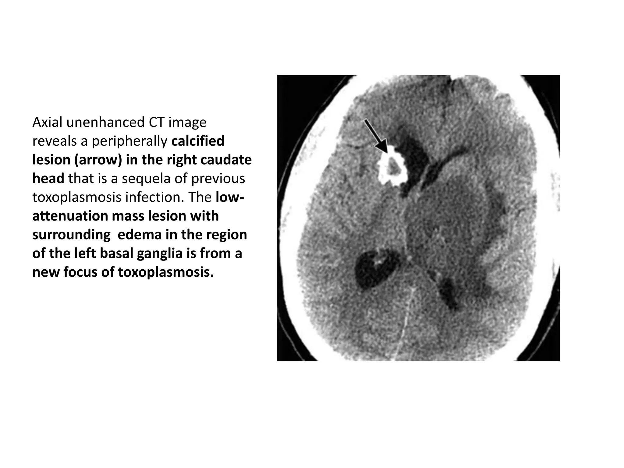 Intracranial infections | PPT